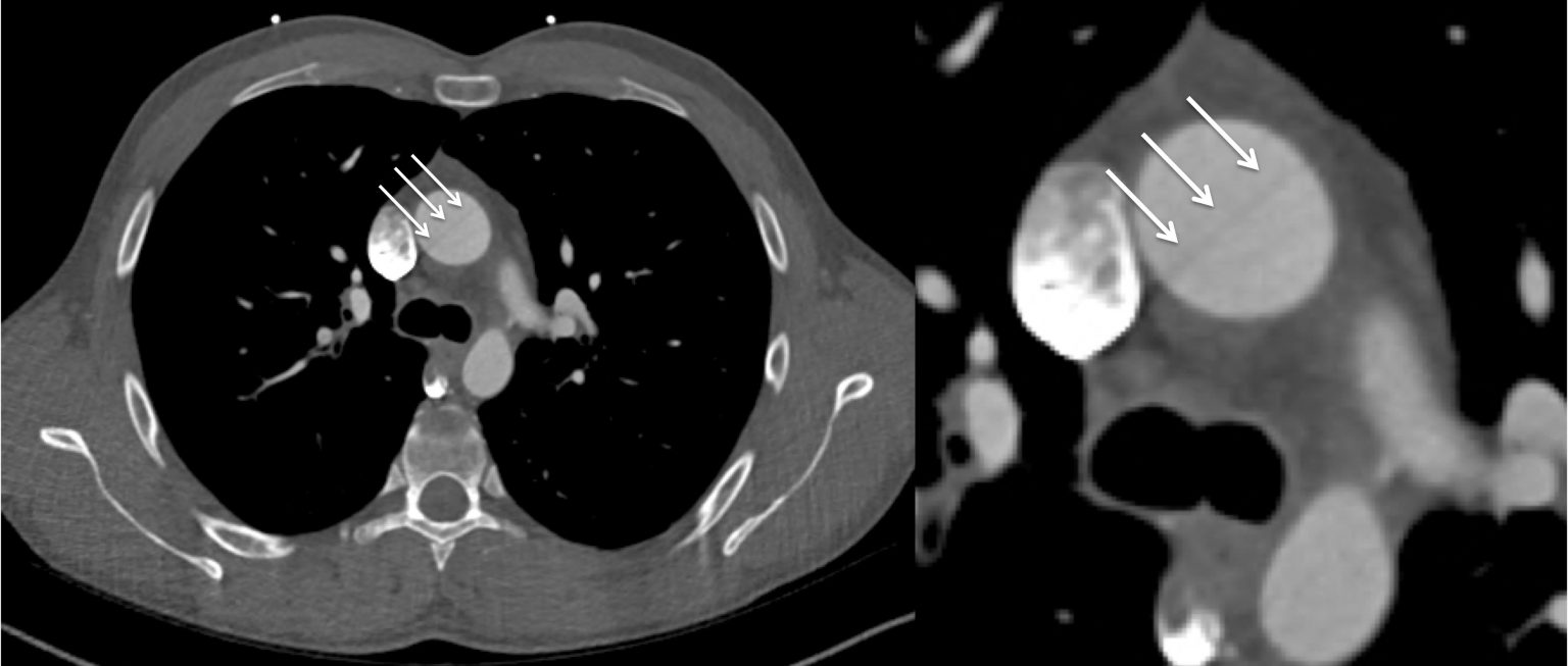 Image of the Month March 2020- Interpolation Reconstruction Artefact On ...