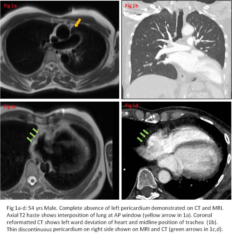 Image of the Month February 2025: Congenital Absence of the Pericardium ...