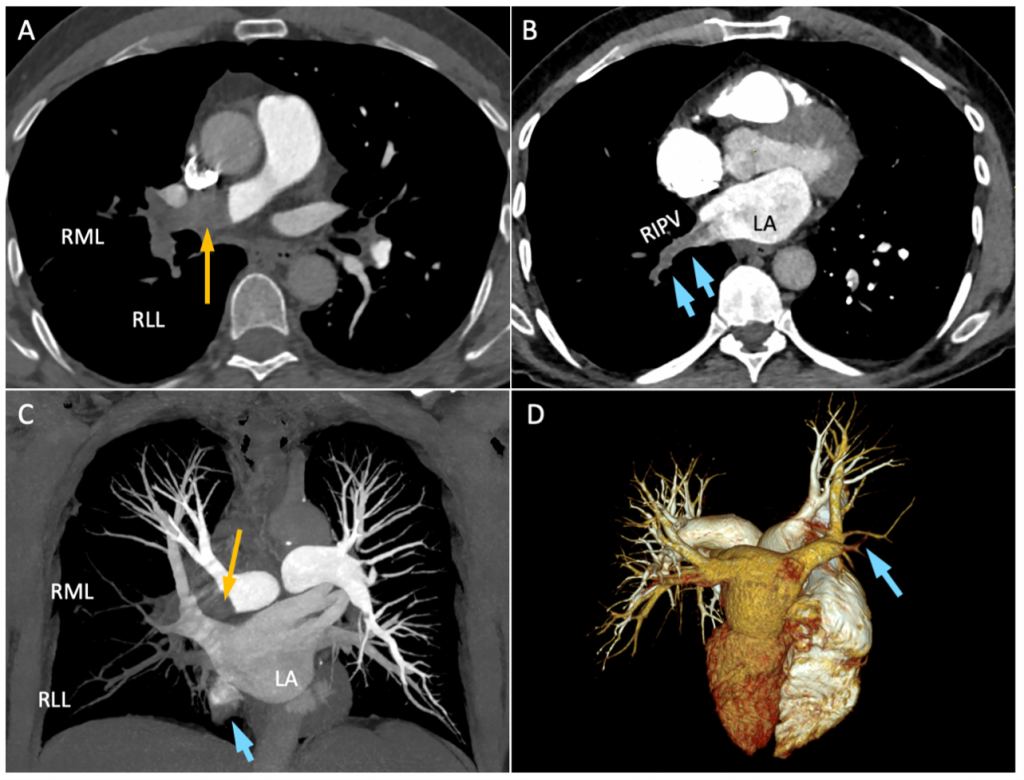 Image of the Month July 2025: Pulmonary vein sign due to acute ...