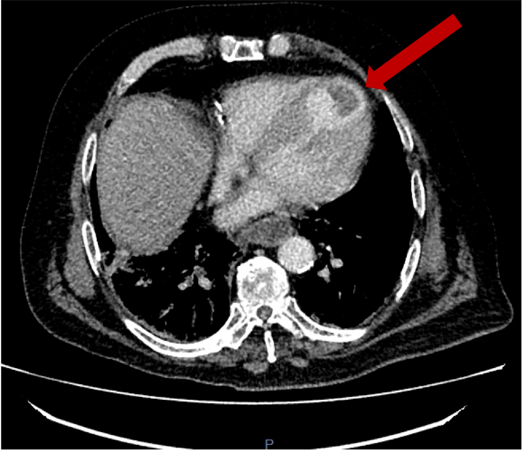 Image of the Month August 2025: ‘Incidental’ finding of LV thrombus in ...