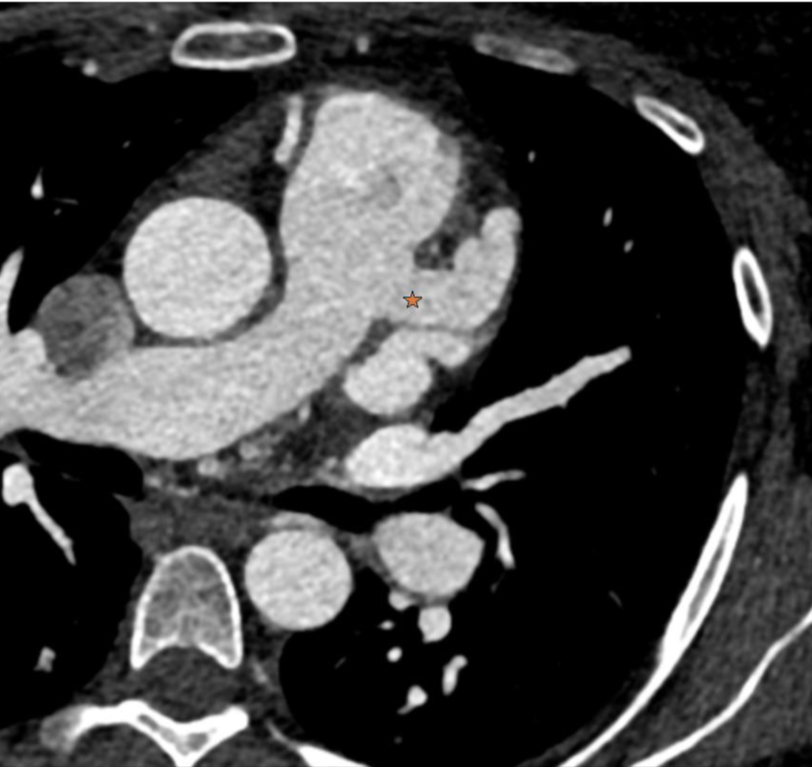 Image of the Month October 2025: Anomalous Origin of the Left Anterior ...