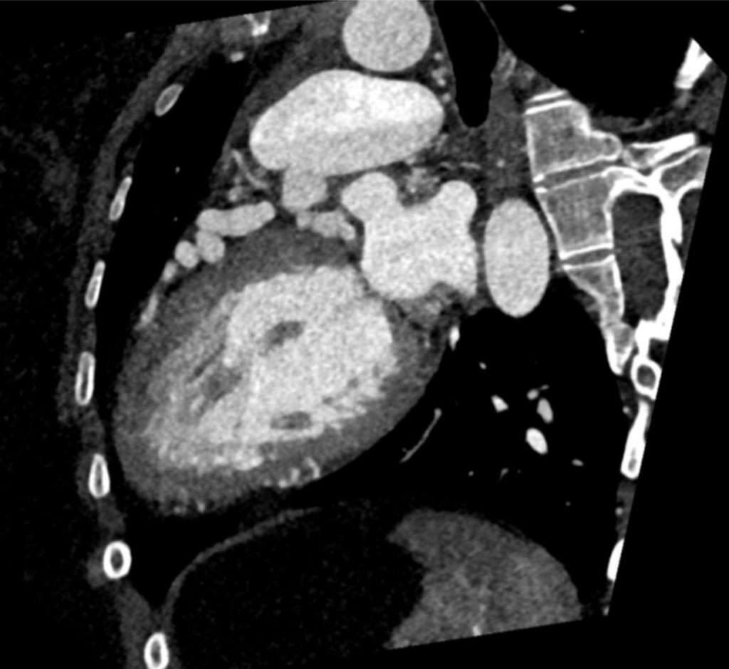 Image of the Month October 2025: Anomalous Origin of the Left Anterior ...