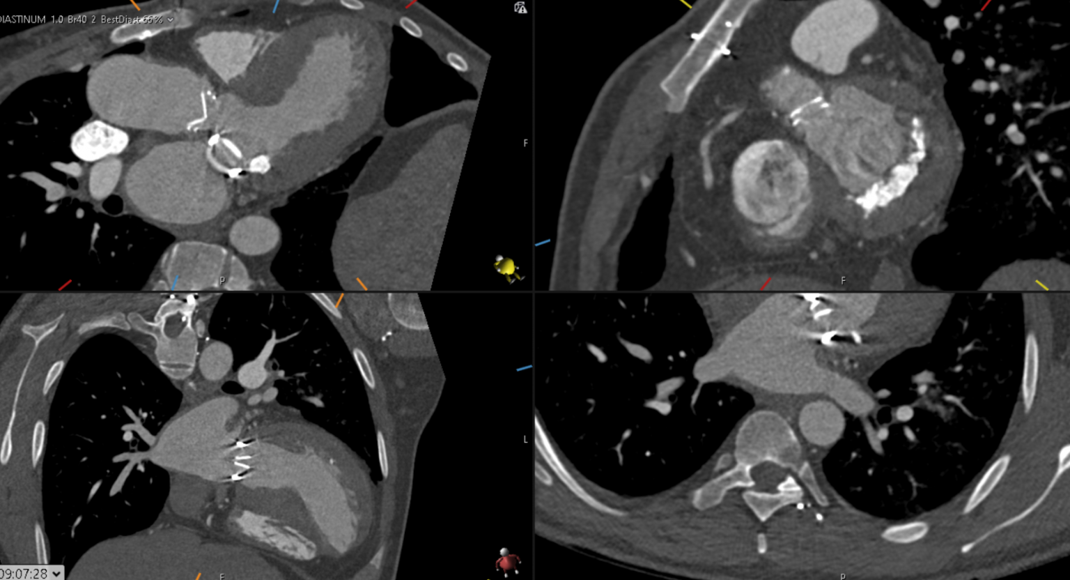 Image of the Month November 2025 - Use of cardiac CT to assess valves ...